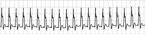 ECG Abnormalities | almostadoctor